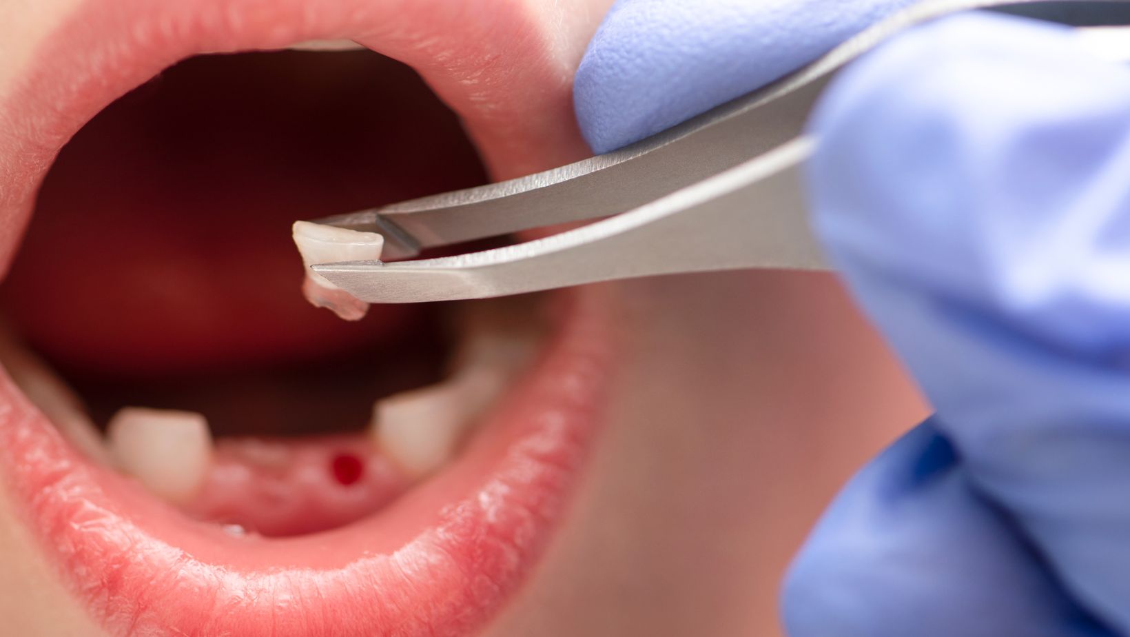 What to Expect After Tooth Extraction (Timeline & Healing): Practical ...